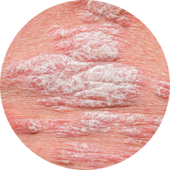 What is Plaque Psoriasis? Pictures, Diagnosis & Treatment