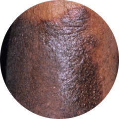 What is Plaque Psoriasis? Pictures, Diagnosis & Treatment