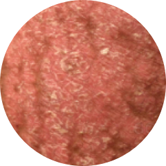 What is Plaque Psoriasis? Pictures, Diagnosis & Treatment