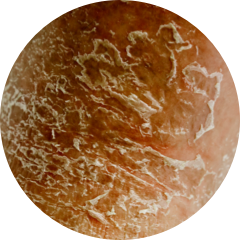 What is Plaque Psoriasis? Pictures, Diagnosis & Treatment