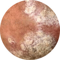 What is Plaque Psoriasis? Pictures, Diagnosis & Treatment