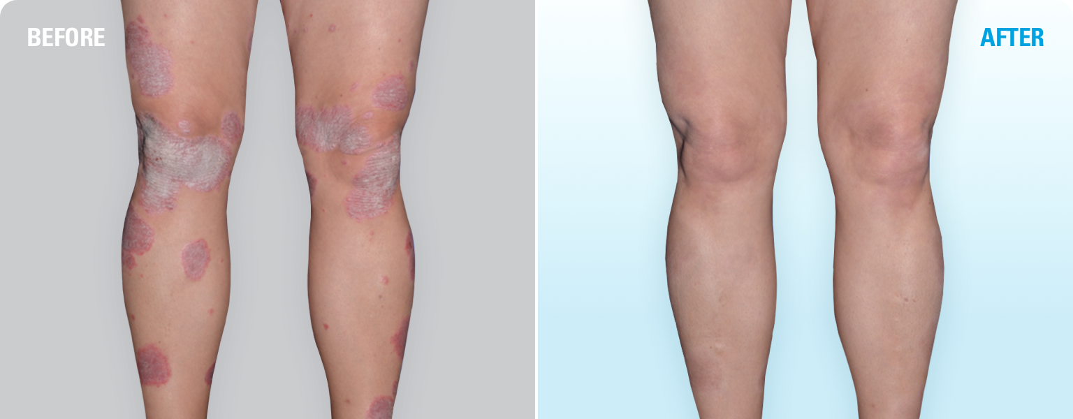 Before & After Pictures | SKYRIZI® (risankizumab‐rzaa)