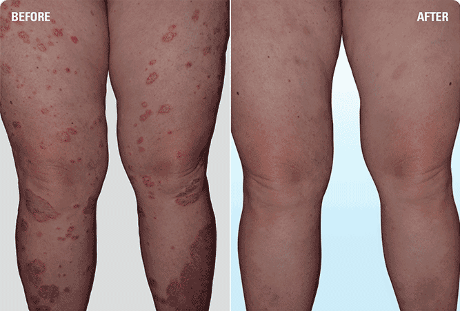 Psoriasis Before And After Pictures Skyrizi® Risankizumab‐rzaa